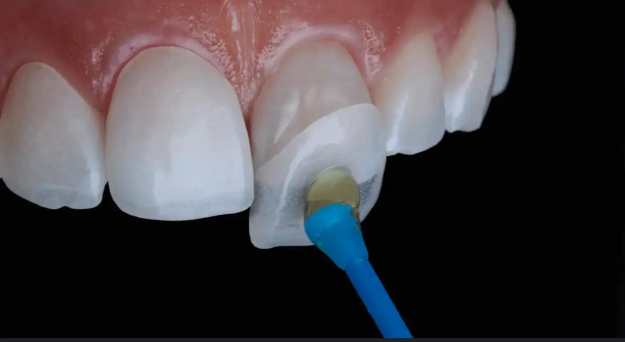 Diseño de sonrisa - Villa Smile